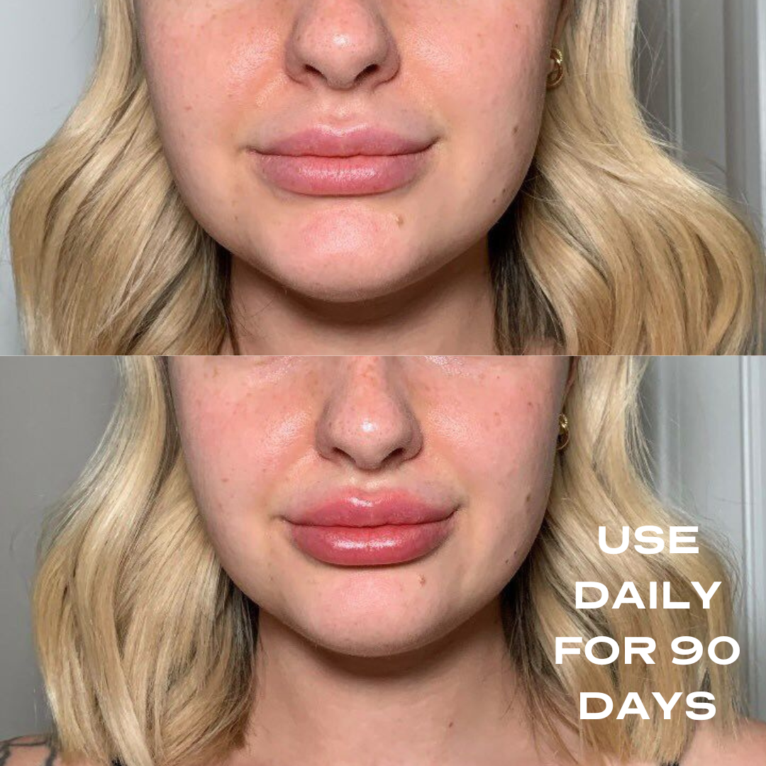No Needles Lip Filler: 1ml 90-Day Package – Plump it!
